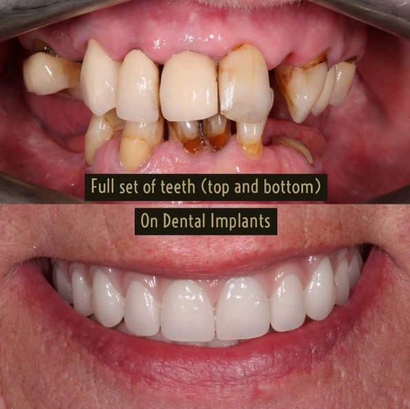 All-on-4 Procedure | How Long, What It's Like & Recovery