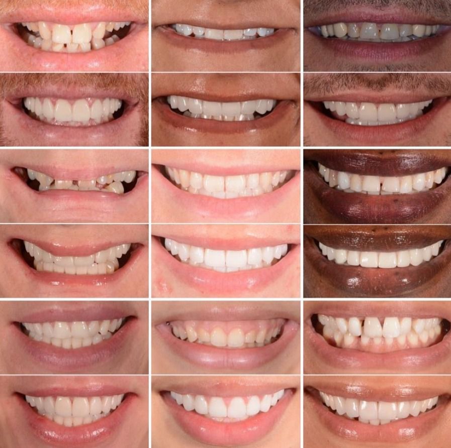 Hollywood Smiles - Before & After | The Perfect Smile Studios