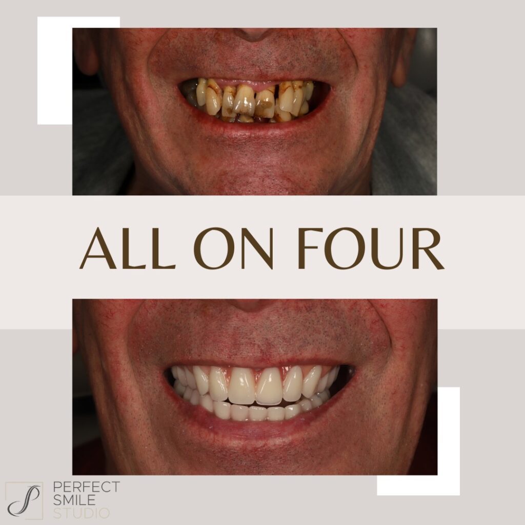 All-on-4 Procedure | How Long, What It's Like & Recovery