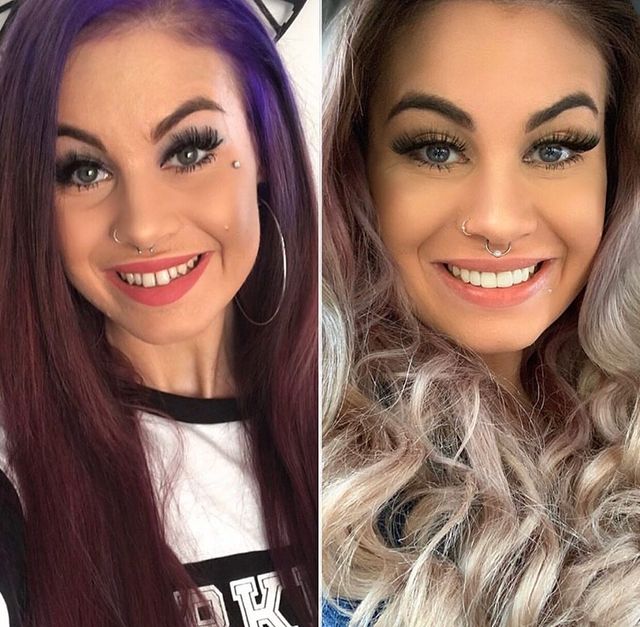 Easiest Way to Fix Protruding Teeth (Teeth That Stick Out)