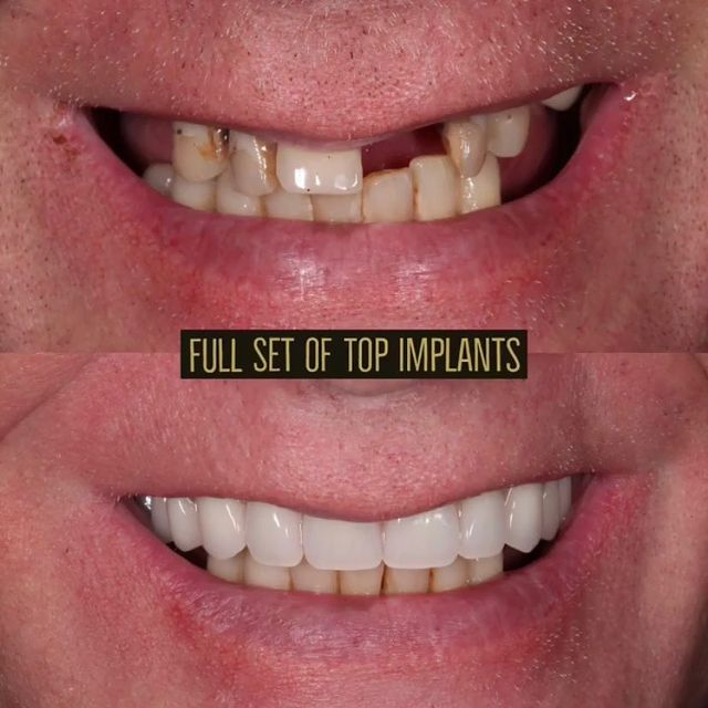 My Teeth Are Rotten What Can I Do? Easy Fixes to Rotten Teeth