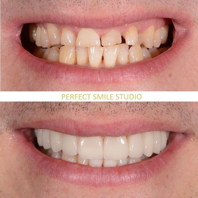 Tooth & Acid Erosion Symptoms & Signs | The Perfect Smile Studios