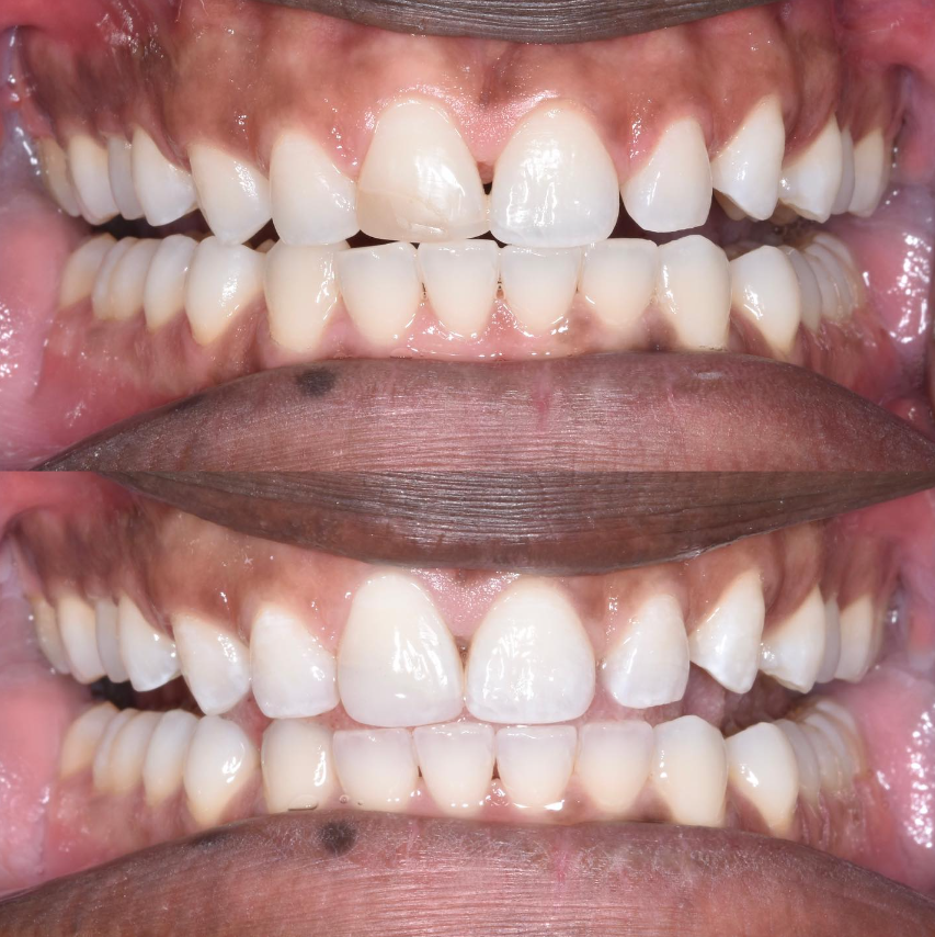 Can a Normal Dentist Do Composite Bonding? | The Perfect Smile Studios
