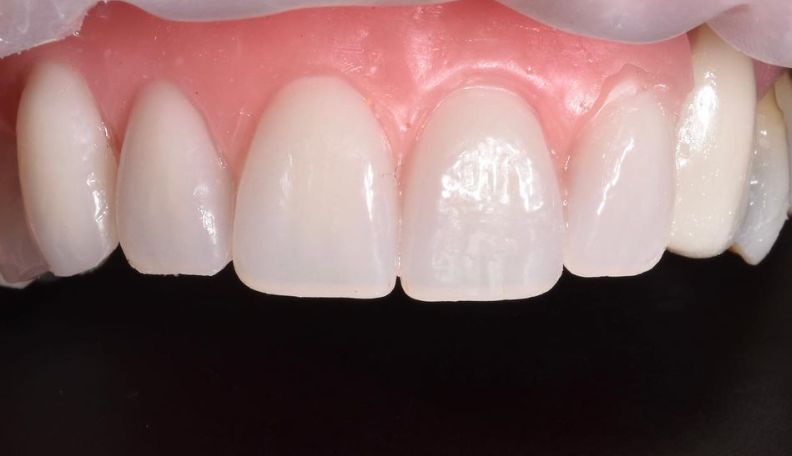 Cost of Types of Dentures | From £850 | The Perfect Smile Studios