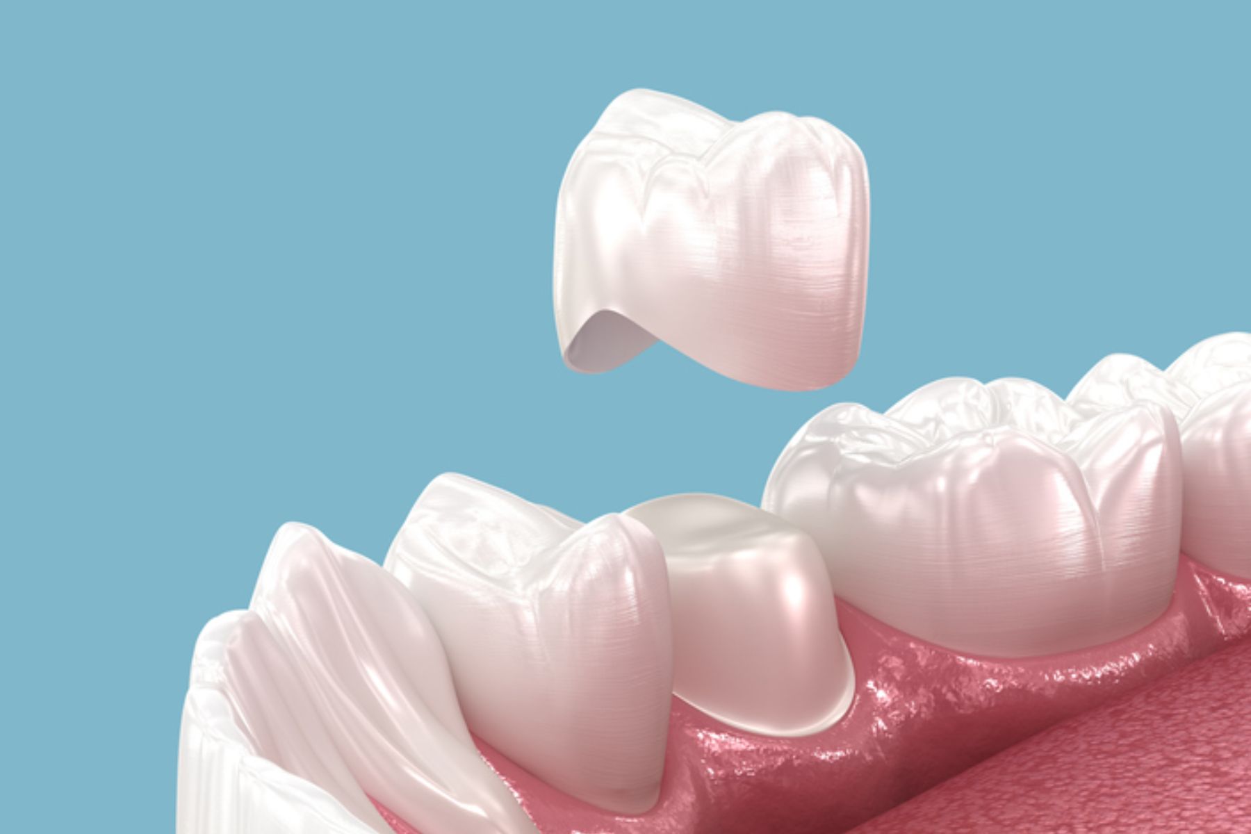 Teeth Prepped for Veneers – How Much Is Removed?