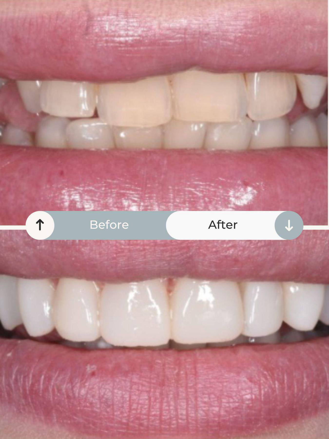 Cosmetic Dentists | Veneers, Bonding, Whitening & More | PSS (Herts)