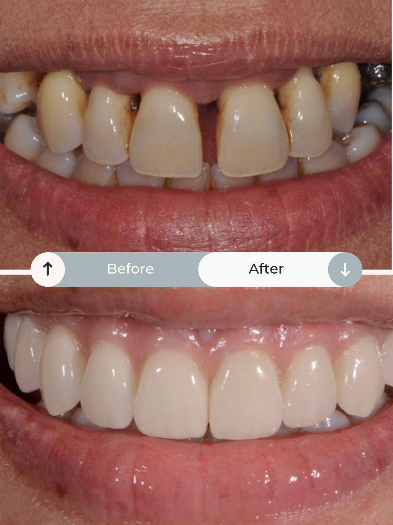 All-on-4 Procedure | How Long, What It's Like & Recovery