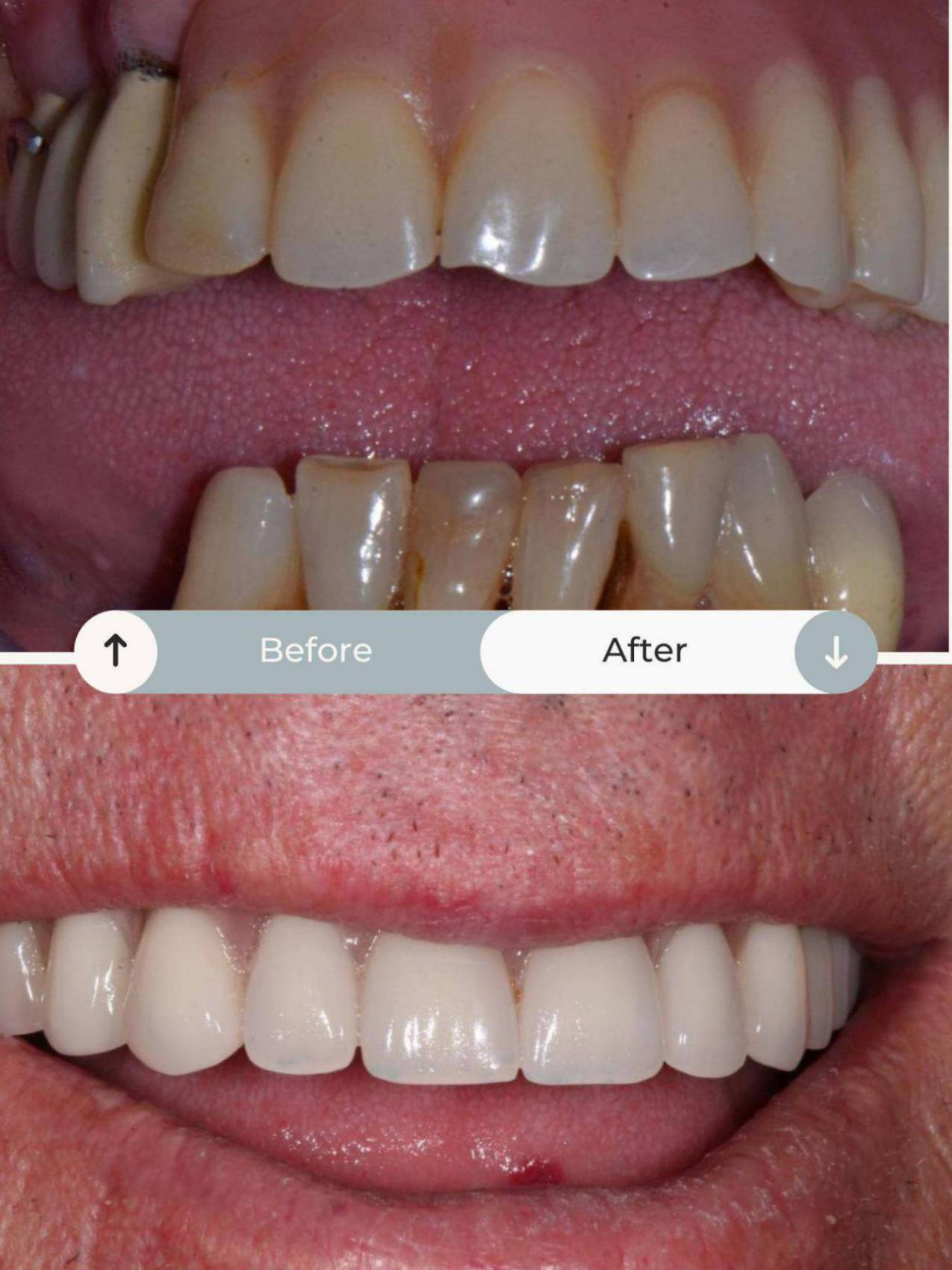 All-on-4 Procedure | How Long, What It's Like & Recovery