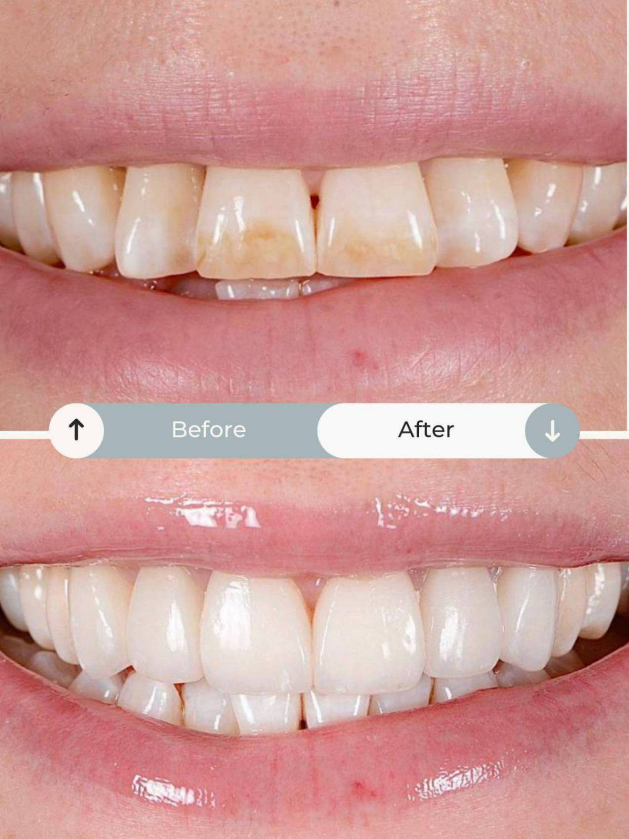 How Much are Turkey Teeth? | Compared to UK Costs | The Perfect Smile ...