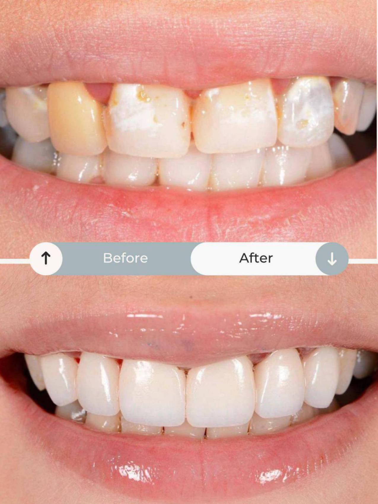 Bad Composite Bonding - What to Look Out For | The Perfect Smile Studios
