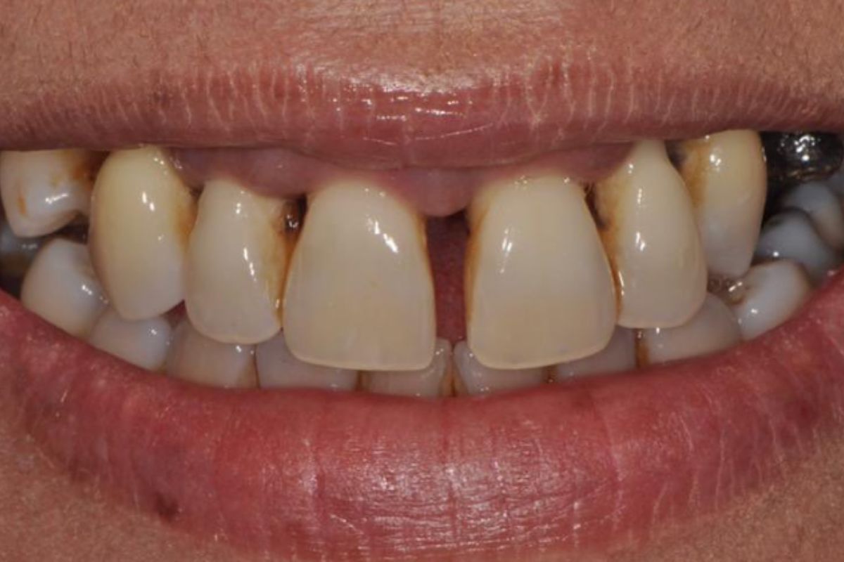 How Far Can Gums Recede Before Teeth Fall Out? | The Perfect Smile Studios