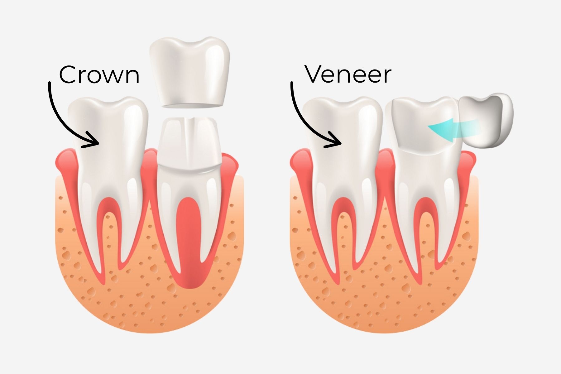 How Much are Turkey Teeth? | Compared to UK Costs | The Perfect Smile ...