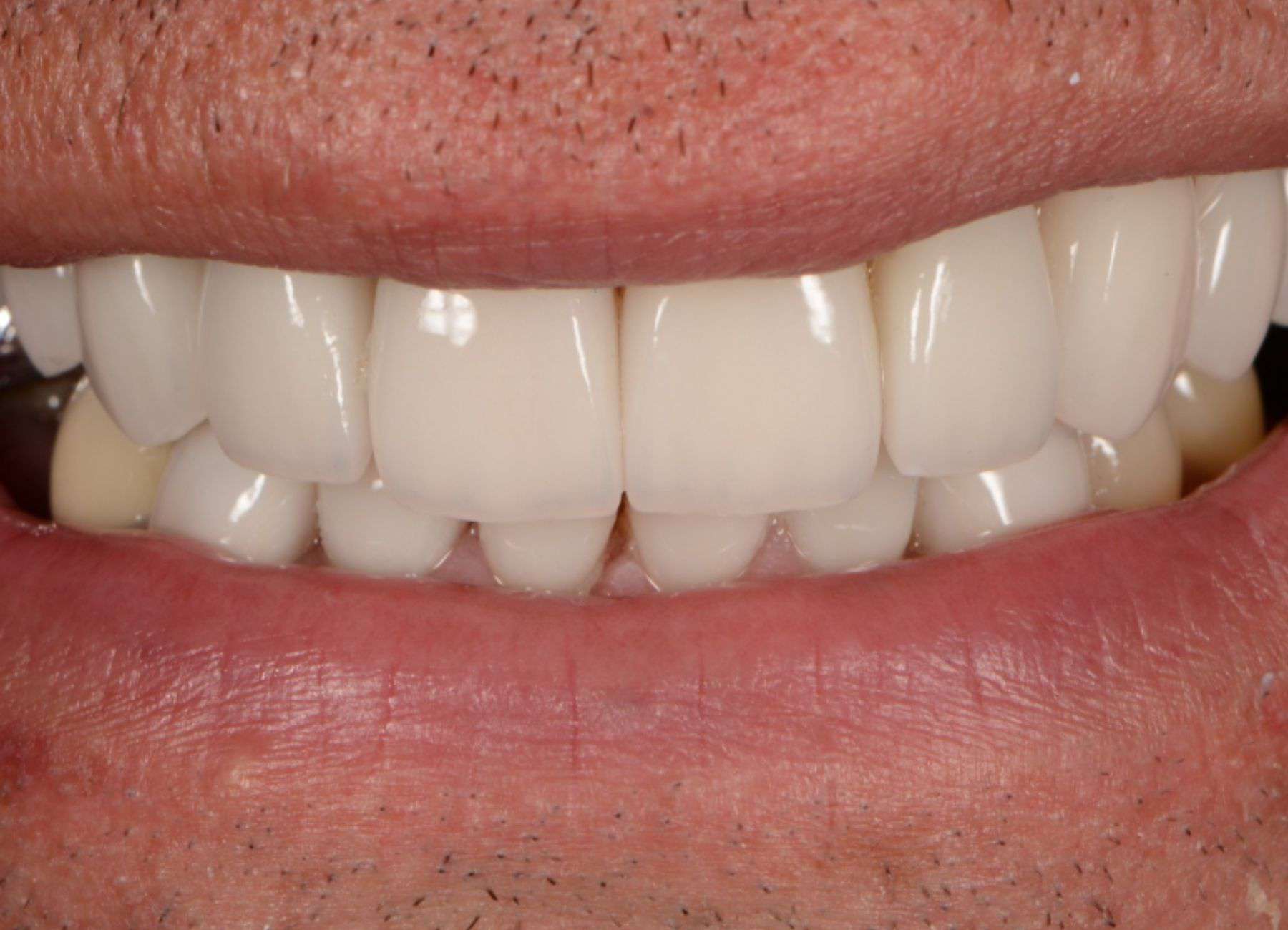 Why Are My Teeth Breaking? Or Crumbling Apart | The Perfect Smile Studios