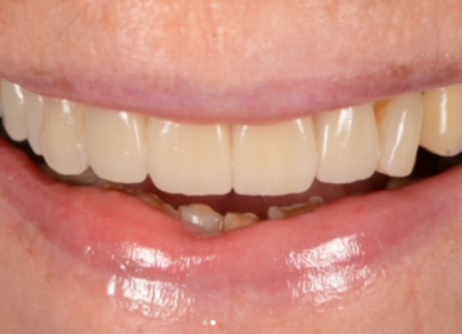 Your Ultimate Guide To Veneer Materials, Types, Shapes & Shades | The ...