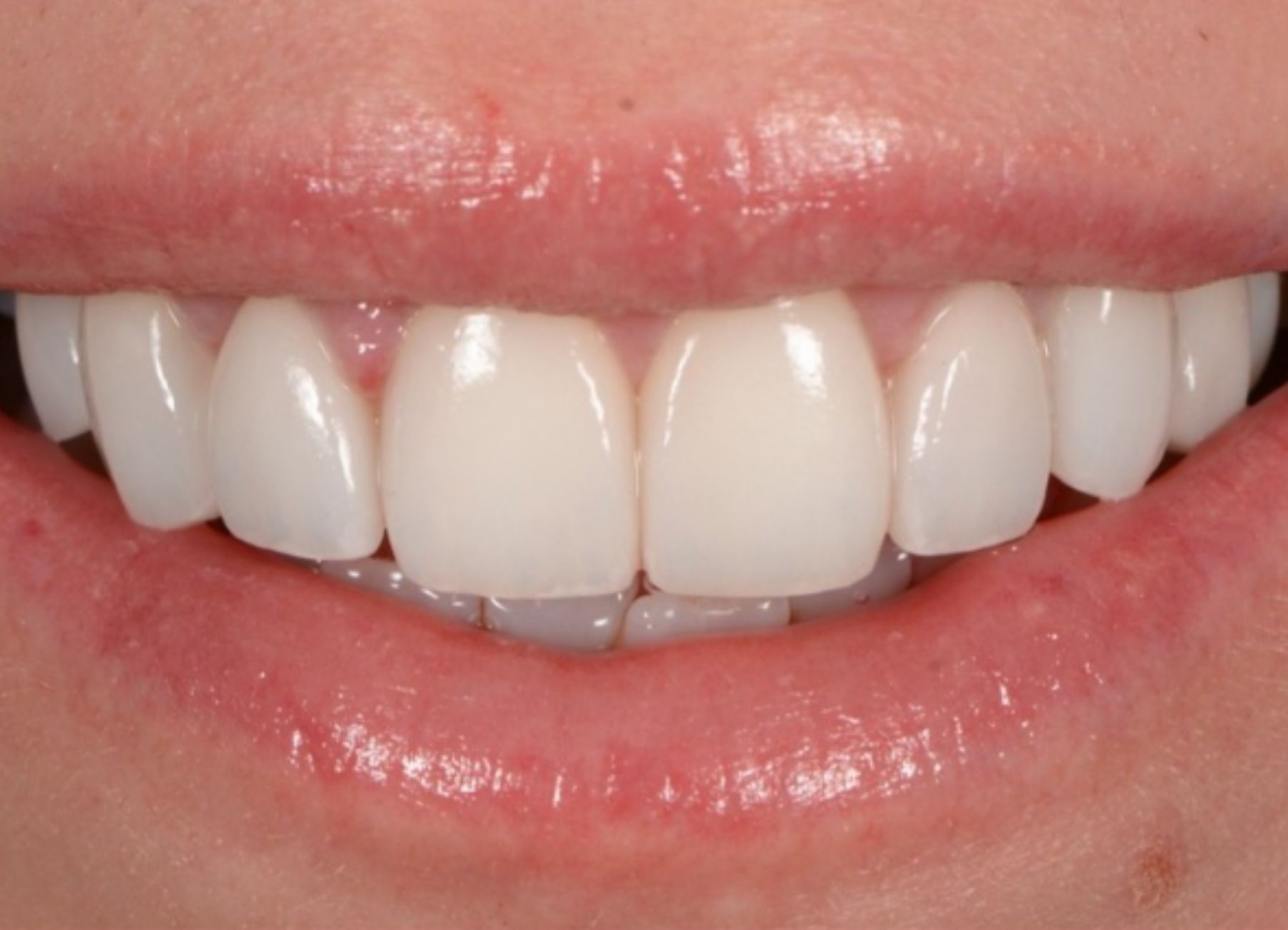 Why Are My Teeth Breaking? Or Crumbling Apart | The Perfect Smile Studios