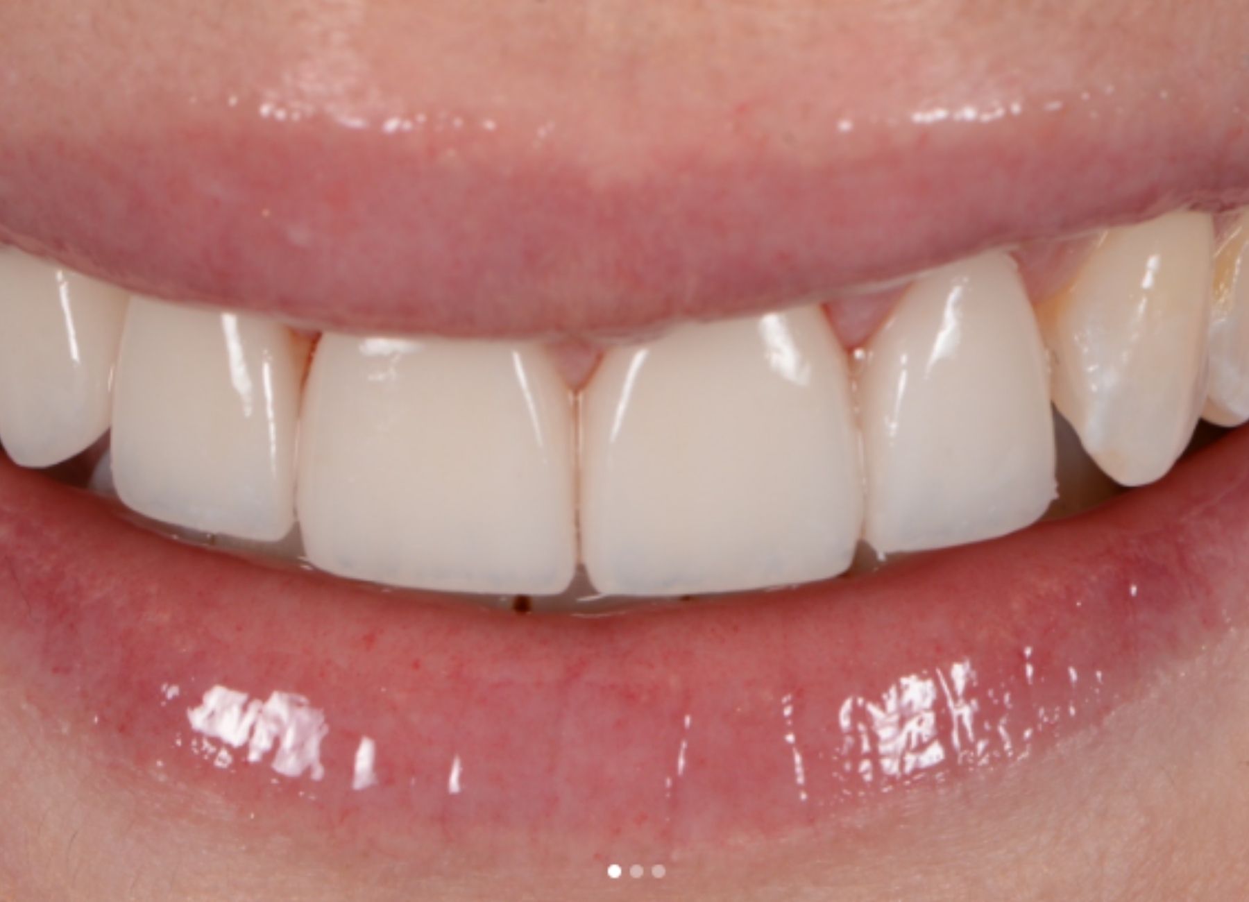 Your Ultimate Guide To Veneer Materials, Types, Shapes & Shades | The ...