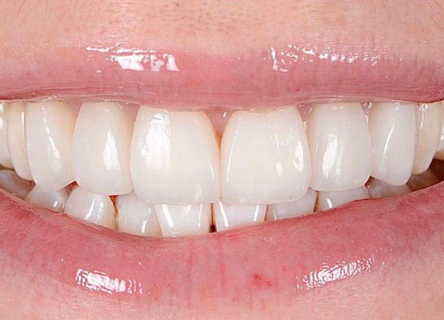 Why Are My Teeth Breaking? Or Crumbling Apart | The Perfect Smile Studios