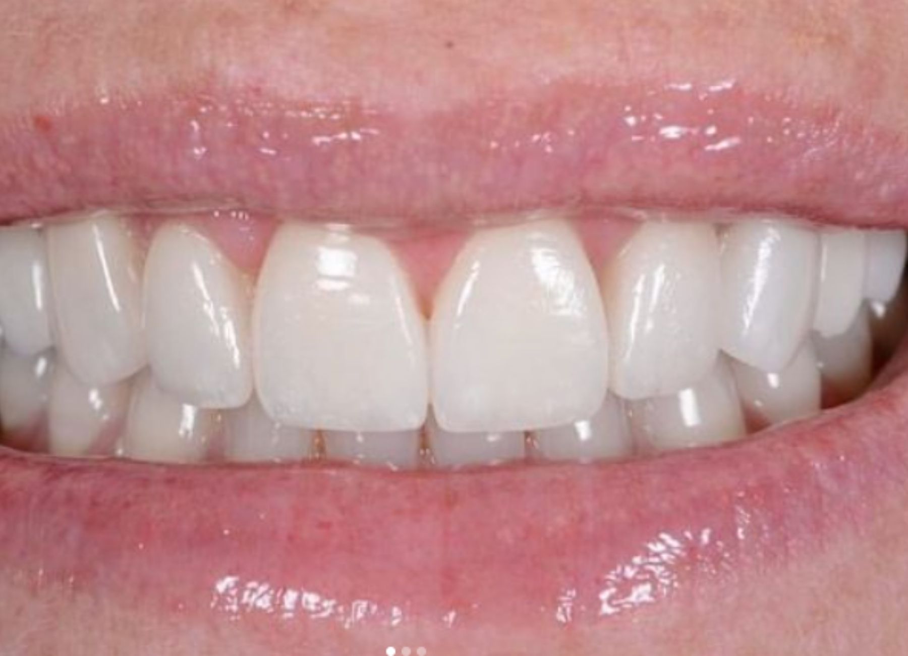 Your Ultimate Guide To Veneer Materials, Types, Shapes & Shades | The ...