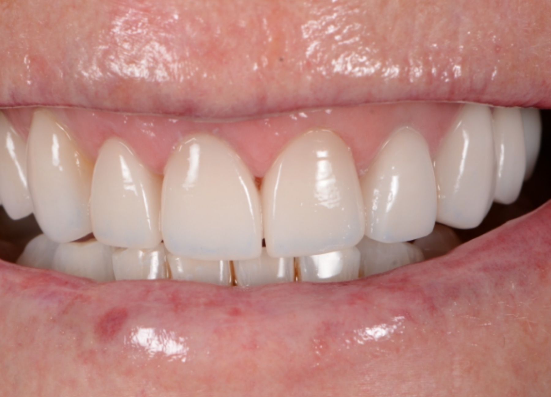 Why Are My Teeth Breaking? Or Crumbling Apart | The Perfect Smile Studios