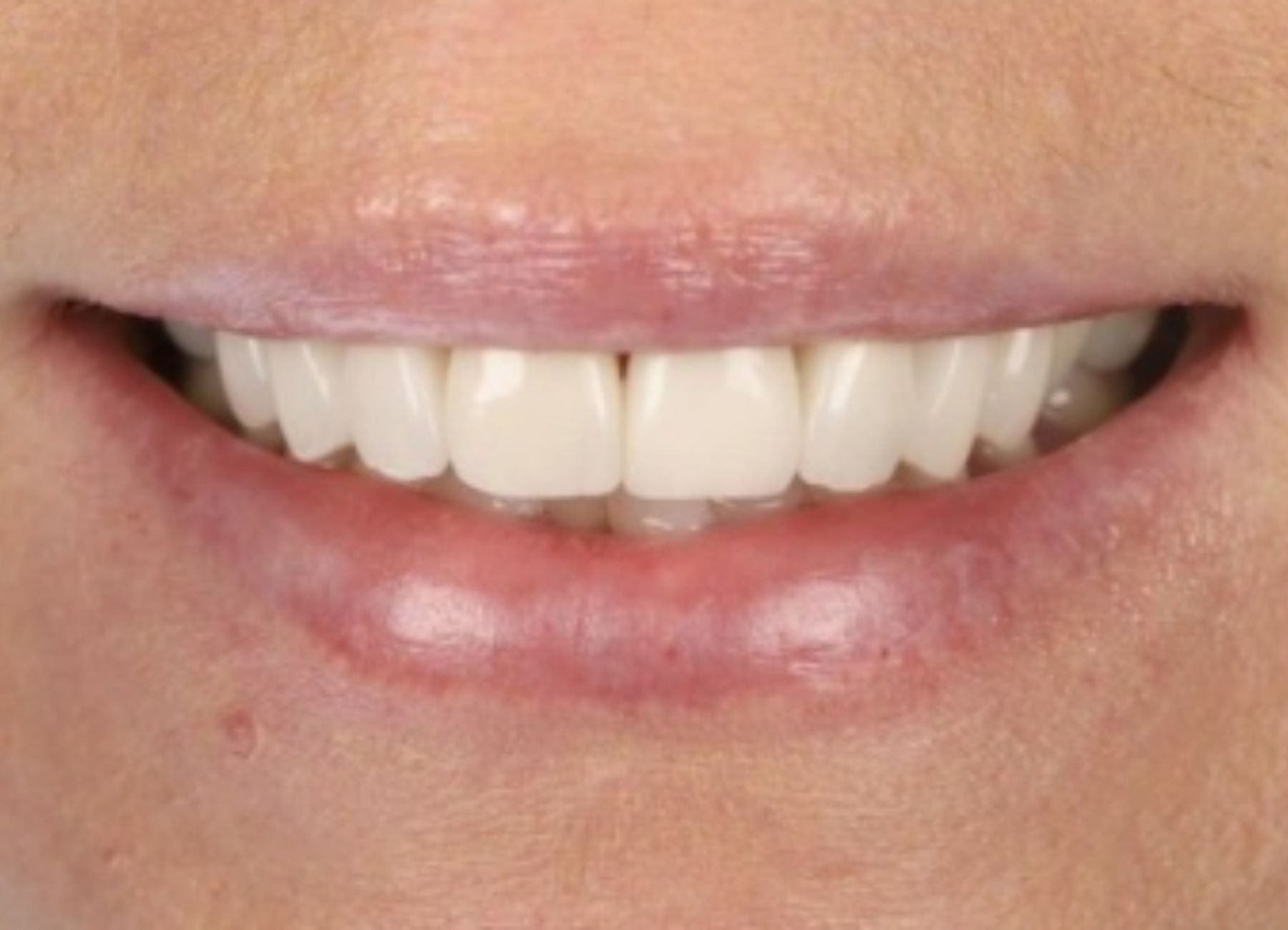 Why Are My Teeth Breaking? Or Crumbling Apart | The Perfect Smile Studios