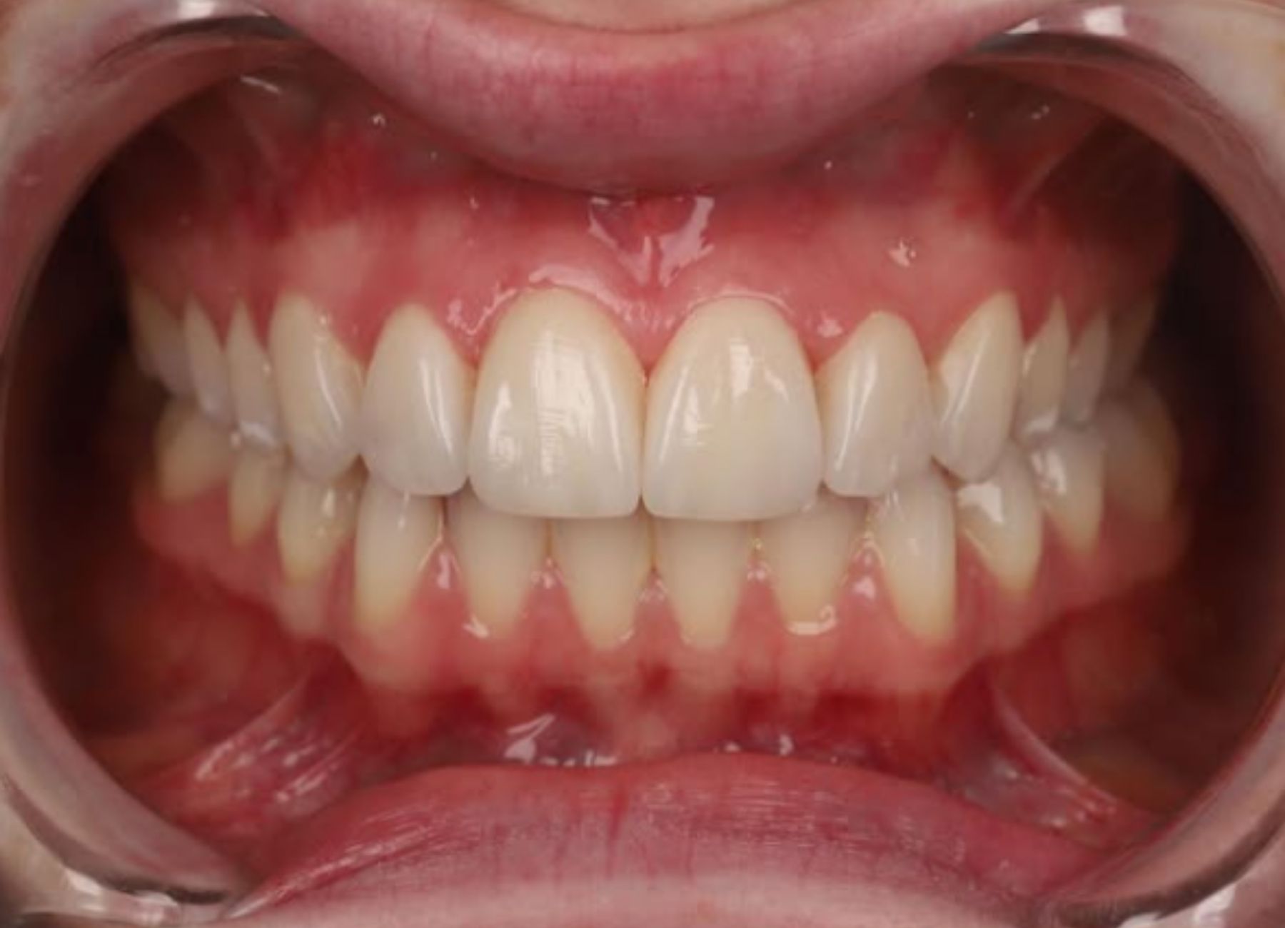 Your Ultimate Guide To Veneer Materials, Types, Shapes & Shades | The ...