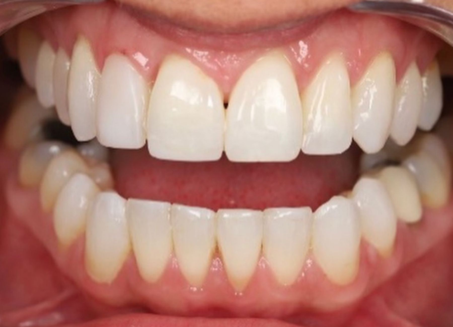 Your Ultimate Guide To Veneer Materials, Types, Shapes & Shades | The ...