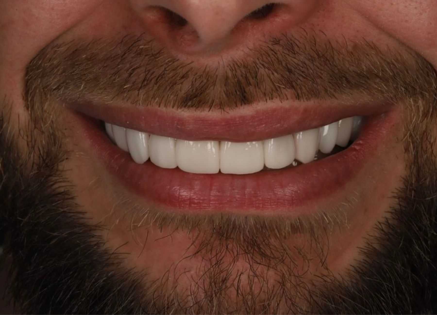 Why Are My Teeth Breaking? Or Crumbling Apart | The Perfect Smile Studios