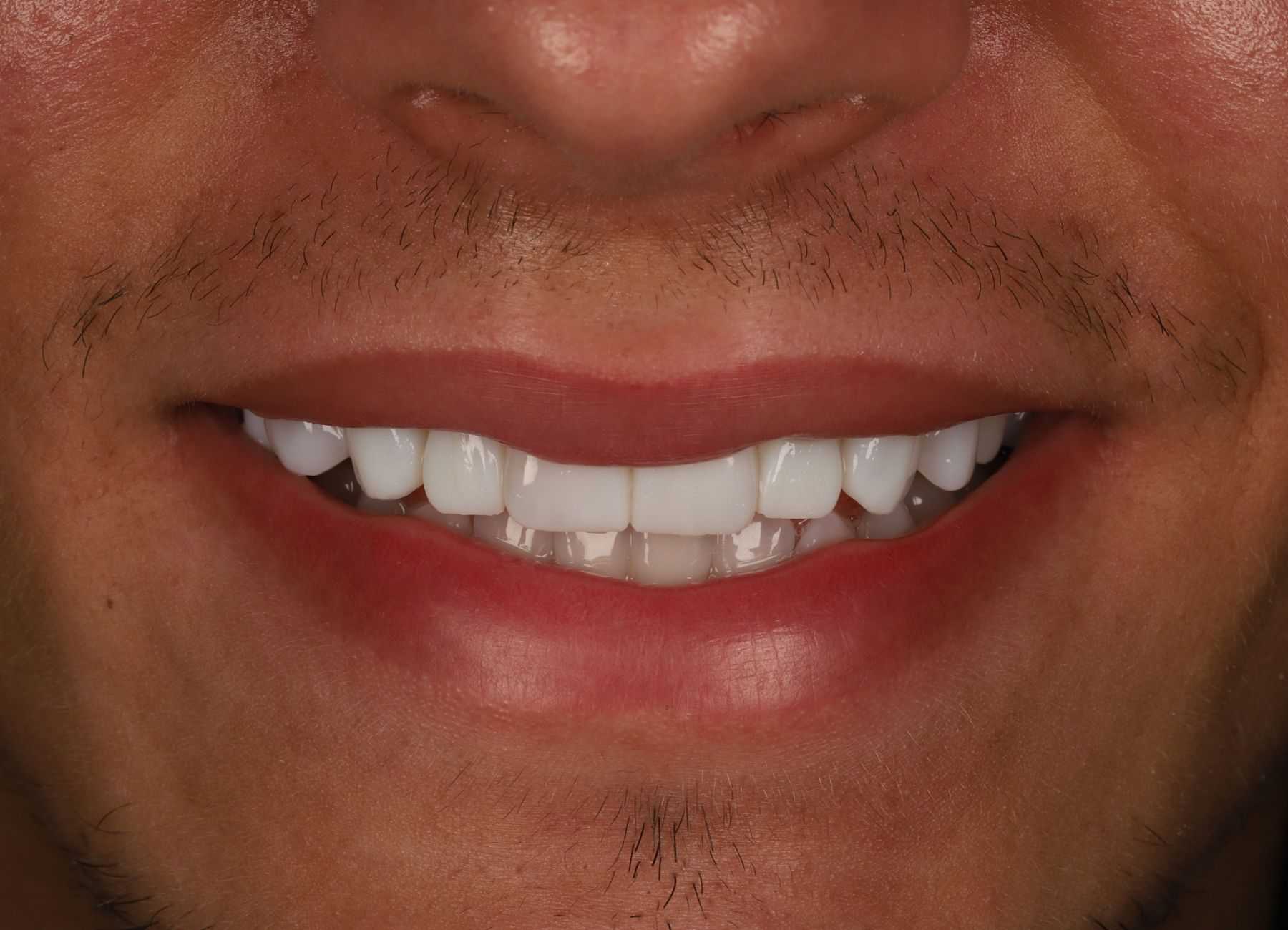 Why Are My Teeth Breaking? Or Crumbling Apart | The Perfect Smile Studios