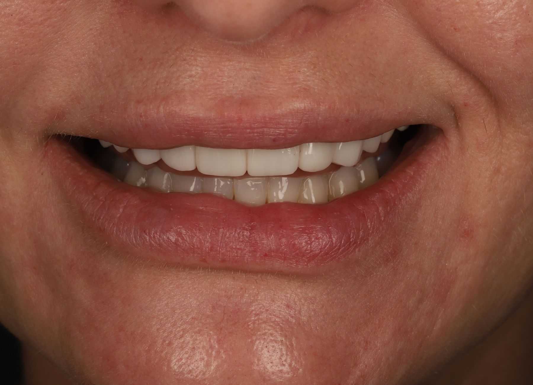 Your Ultimate Guide To Veneer Materials, Types, Shapes & Shades | The ...