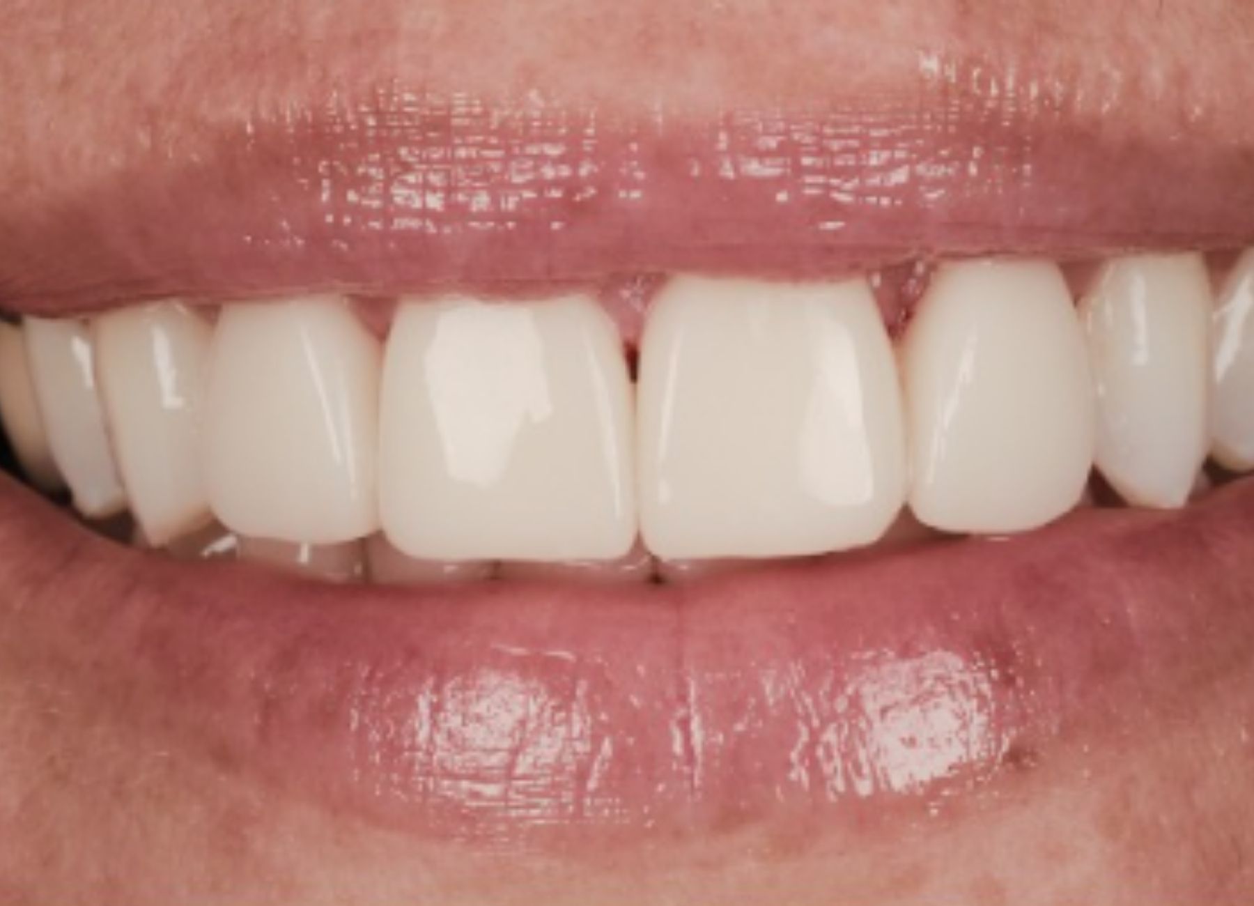 Why Are My Teeth Breaking? Or Crumbling Apart | The Perfect Smile Studios