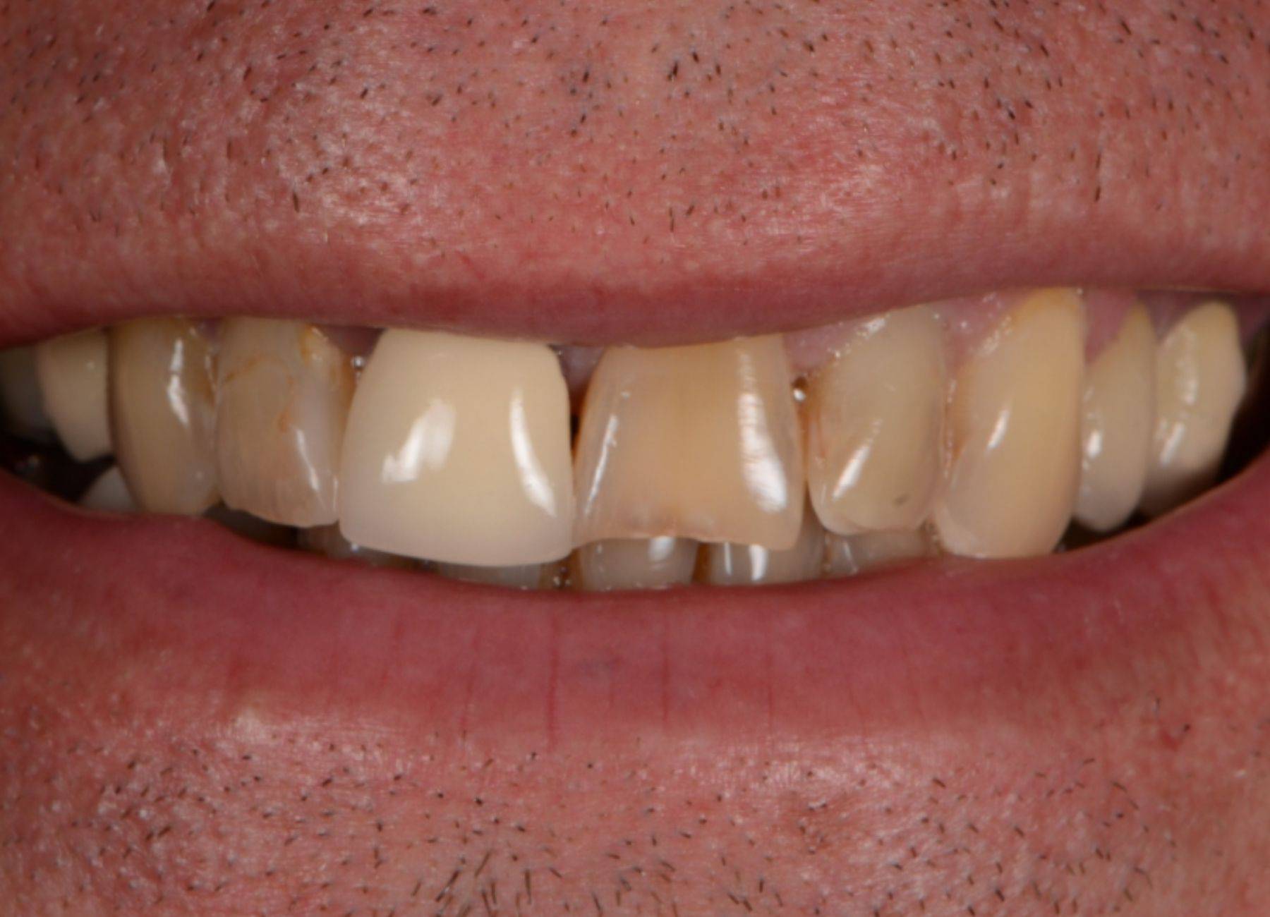 Why Are My Teeth Breaking? Or Crumbling Apart | The Perfect Smile Studios