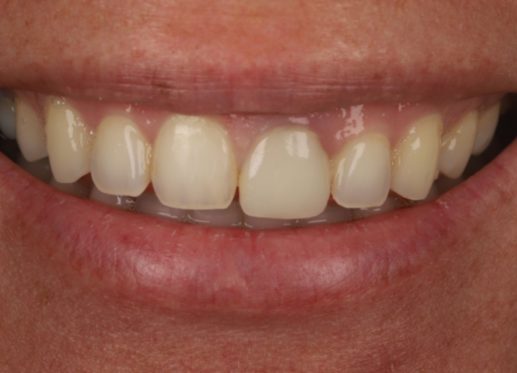 Do You Have To Wear A Retainer Forever? | The Perfect Smile Studios