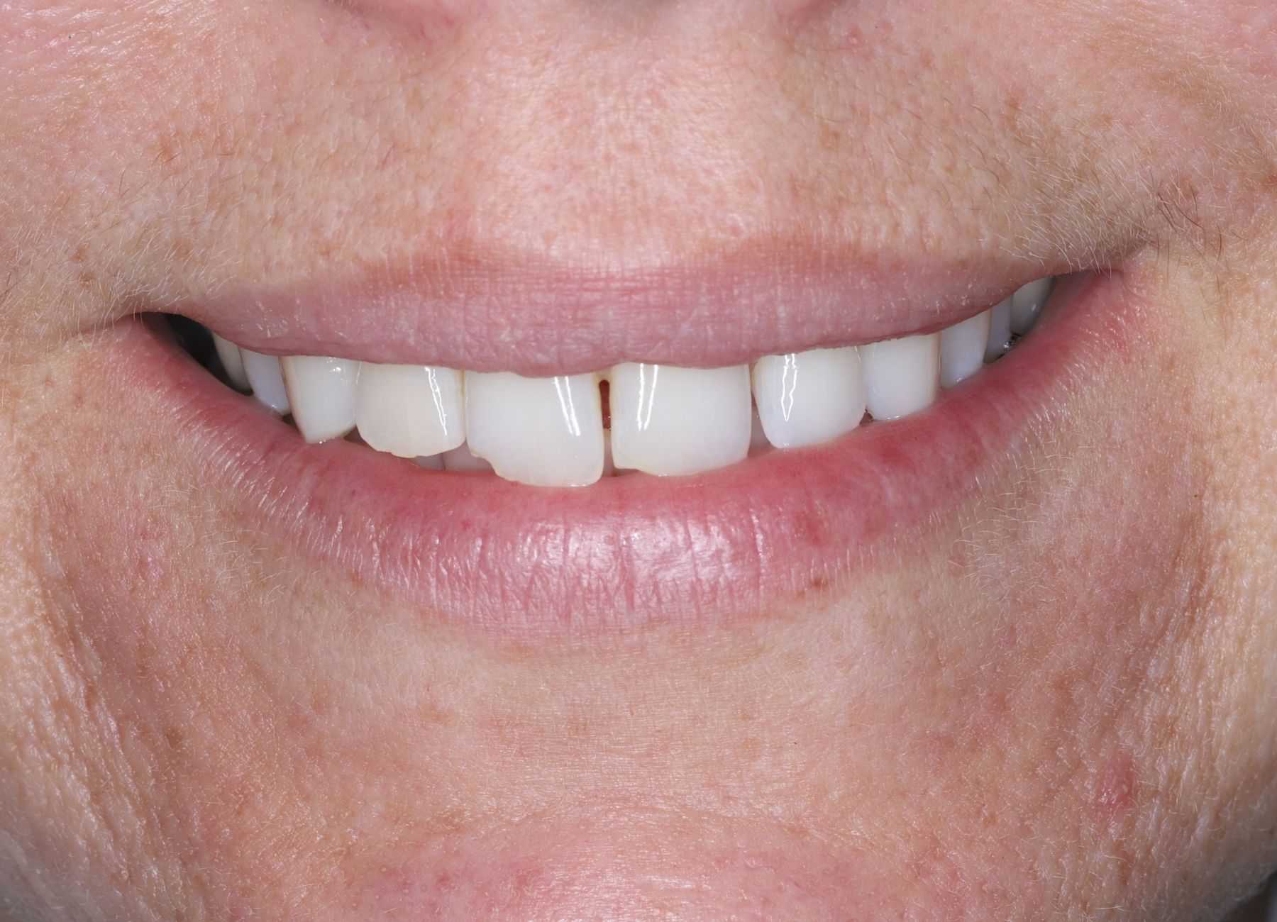 Why Are My Teeth Breaking? Or Crumbling Apart | The Perfect Smile Studios