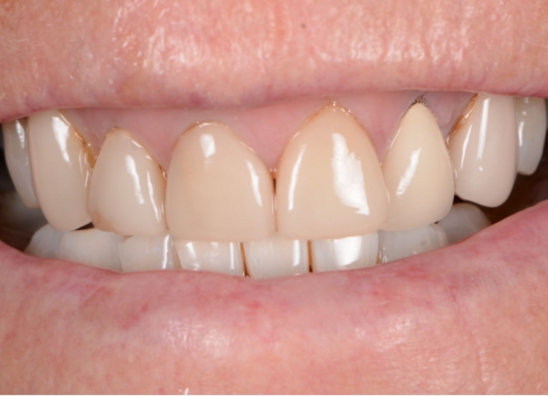 Why Are My Teeth Breaking? Or Crumbling Apart | The Perfect Smile Studios