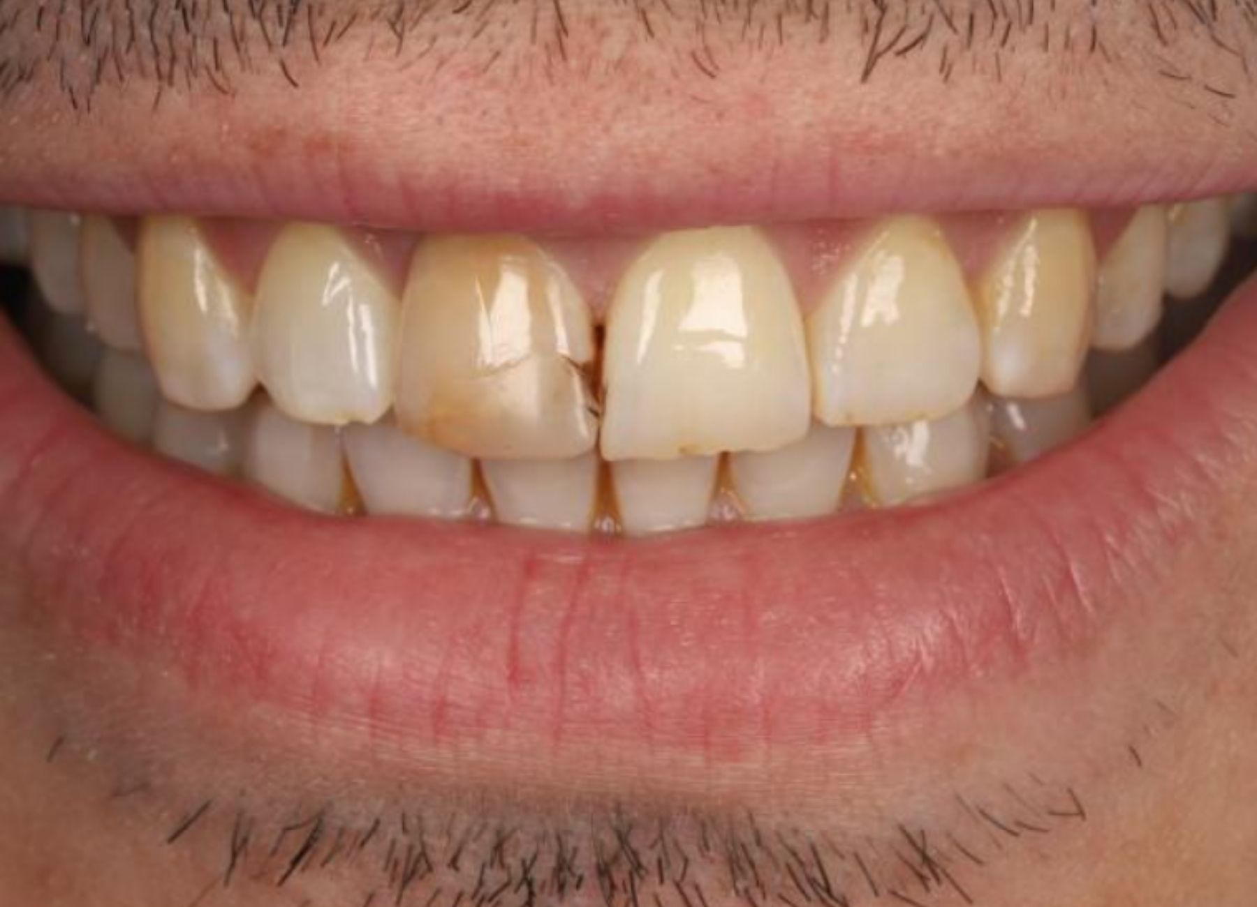 Why Are My Teeth Breaking? Or Crumbling Apart | The Perfect Smile Studios