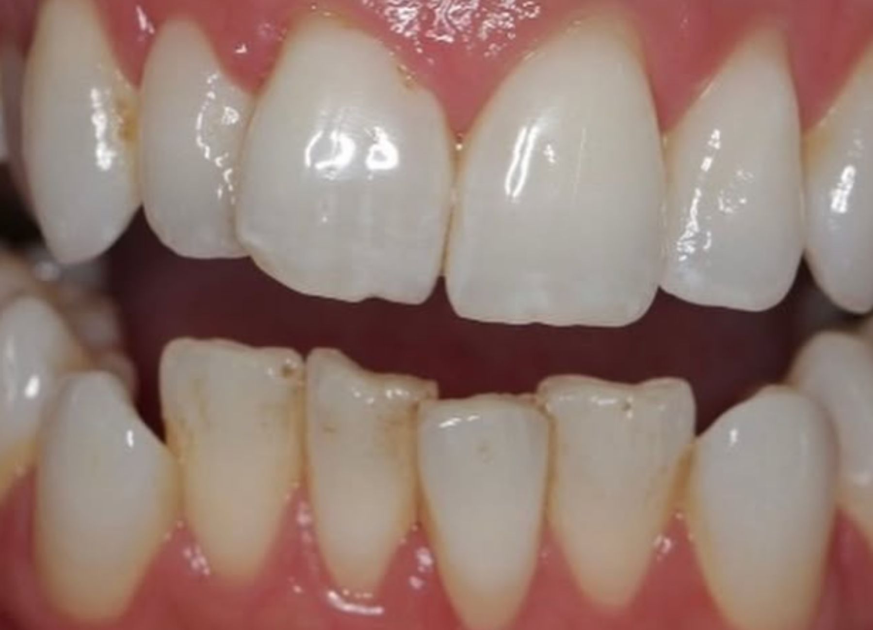 Why Are My Teeth Breaking? Or Crumbling Apart | The Perfect Smile Studios