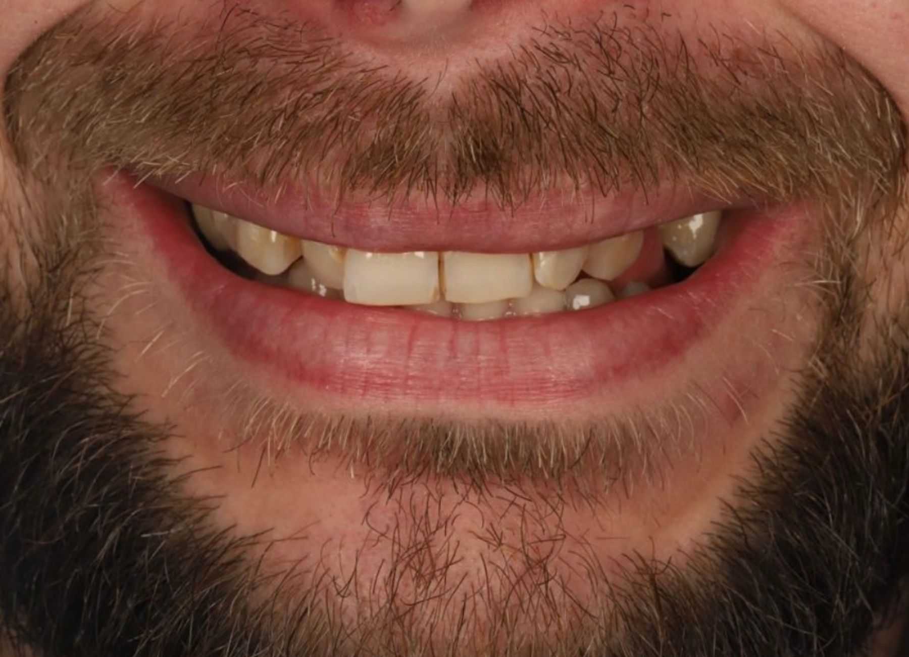 Do You Have To Wear A Retainer Forever? | The Perfect Smile Studios