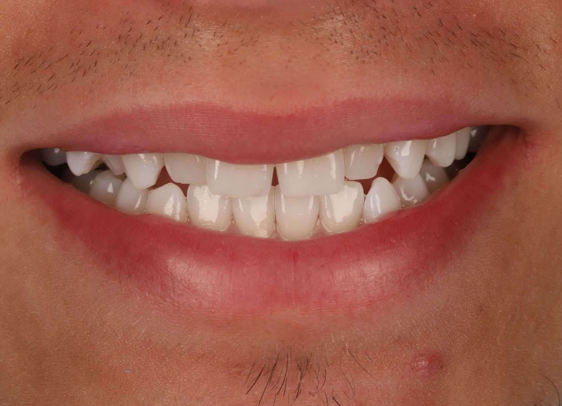 Why Are My Teeth Breaking? Or Crumbling Apart | The Perfect Smile Studios