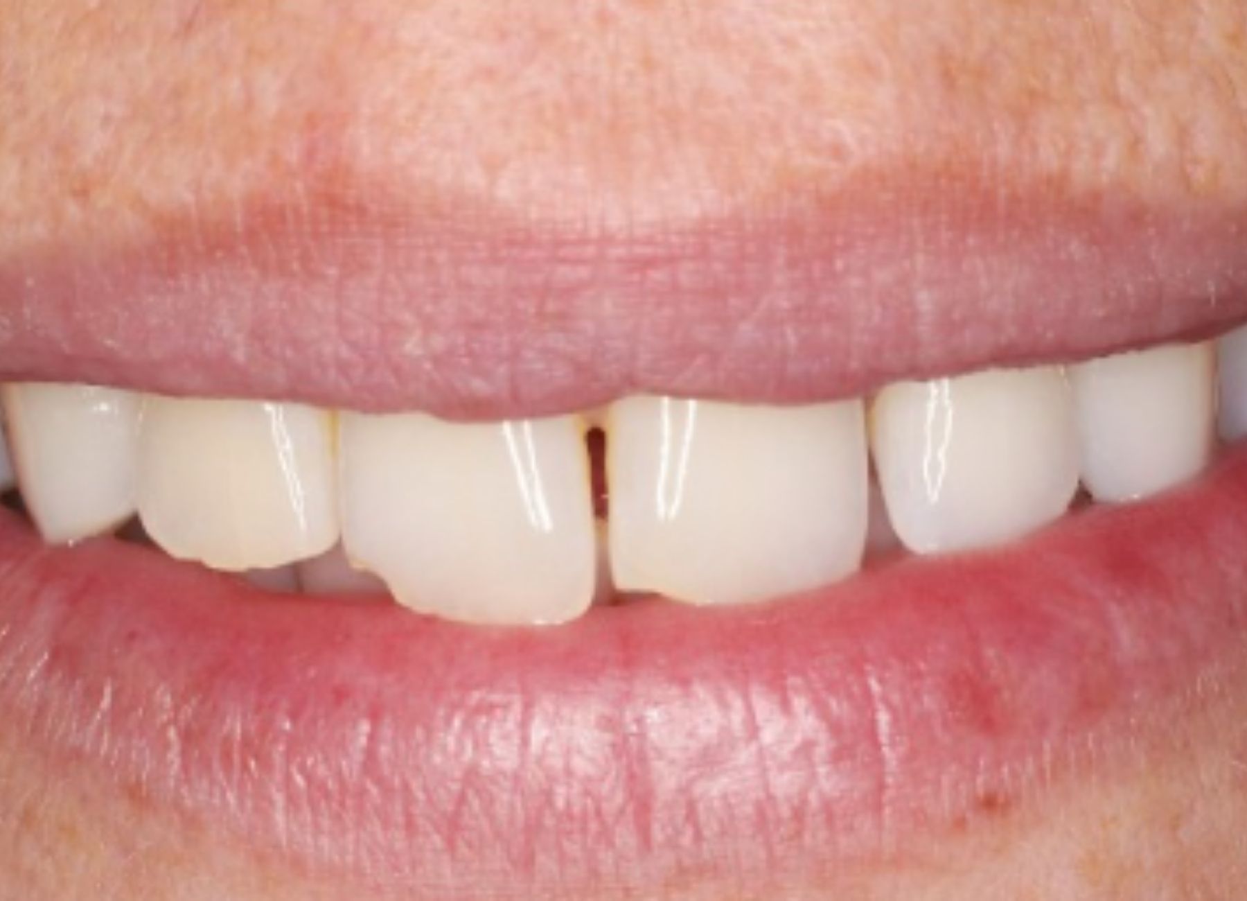 Why Are My Teeth Breaking? Or Crumbling Apart | The Perfect Smile Studios