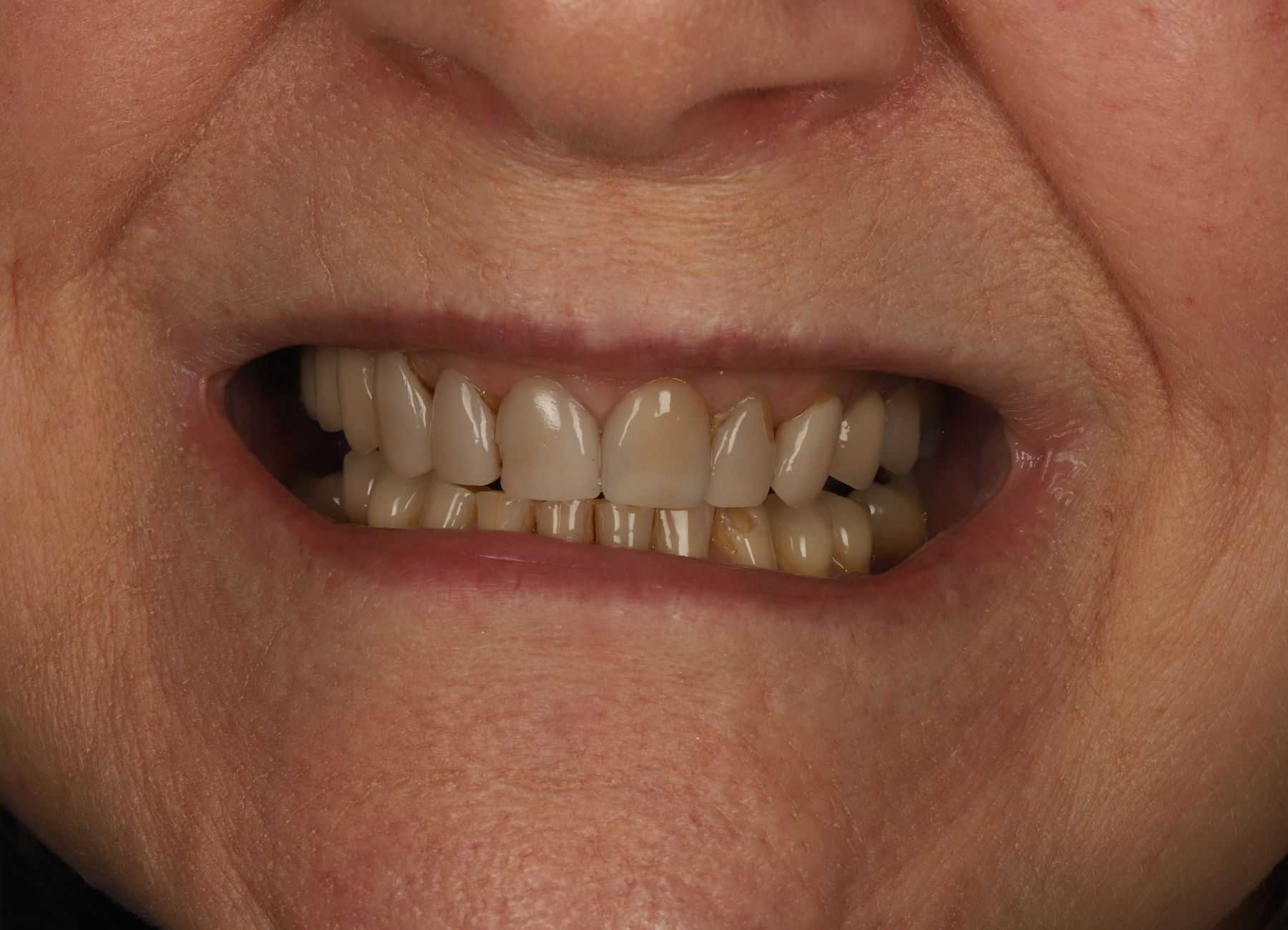 Cheap Veneers UK – Composite Veneers From £500 / £10 PM